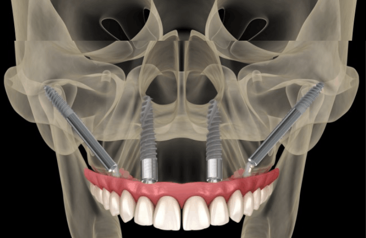 Remote Anchorage Dental Implants for Severe Bone Loss | Fort Worth